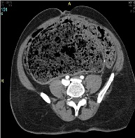Mega colon Secondary to Chronic Constipation - World Journal of Medical ...