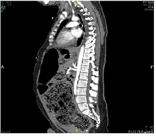 Mega colon Secondary to Chronic Constipation - World Journal of Medical ...