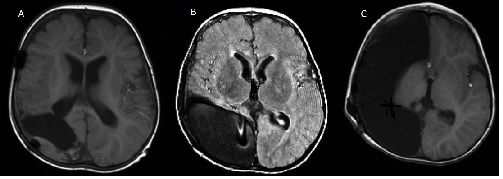 Staged Hemispherotomy in an Infant with Catastrophic Epilepsy without ...
