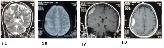 Right Parietal Convexity